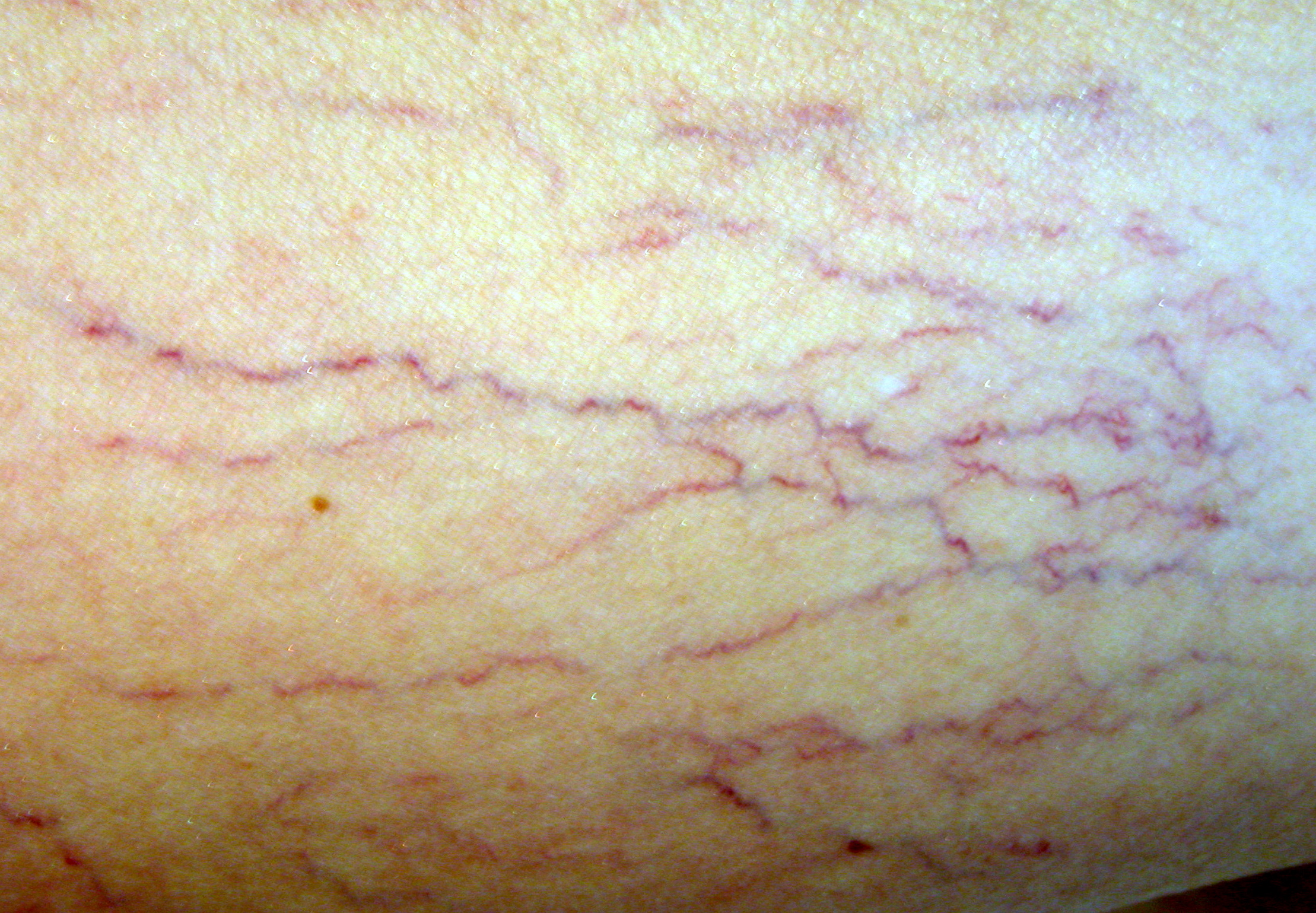 Escleroterapia en Imagenes - Varices Madrid