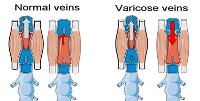Que son las Varices - Varices Madrid